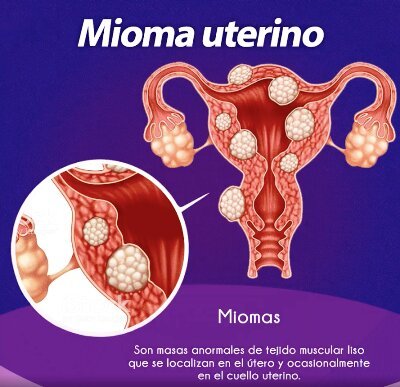 Miomas con Omnilife. Favorece el funcionamiento hormonal de la mujer.